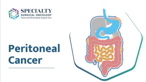 Stages And Treatments Options for Peritoneal Cancer
