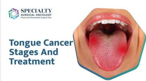 Understanding Oral Cancer Stages - Signs & Treatment Options
